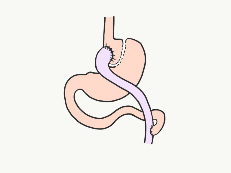 Was genau ist ein Magenbypass? – hallo leichtigkeit